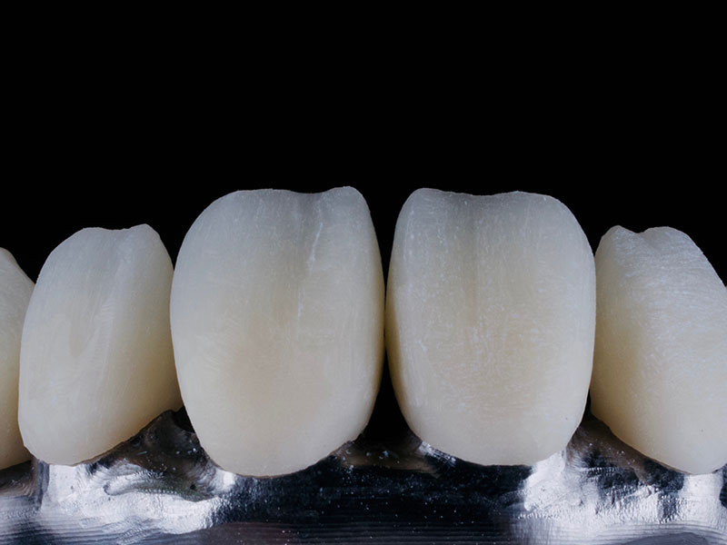 Implants - Beever Dental